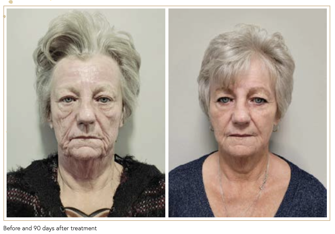 Neogen Facelift - Neogen Treatment Dallas - Unicorn Medspa